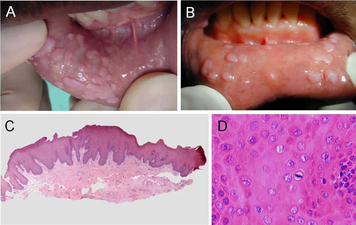 Figure 4 - - Difference Squamous Cell Papilloma Condyloma - Free ...