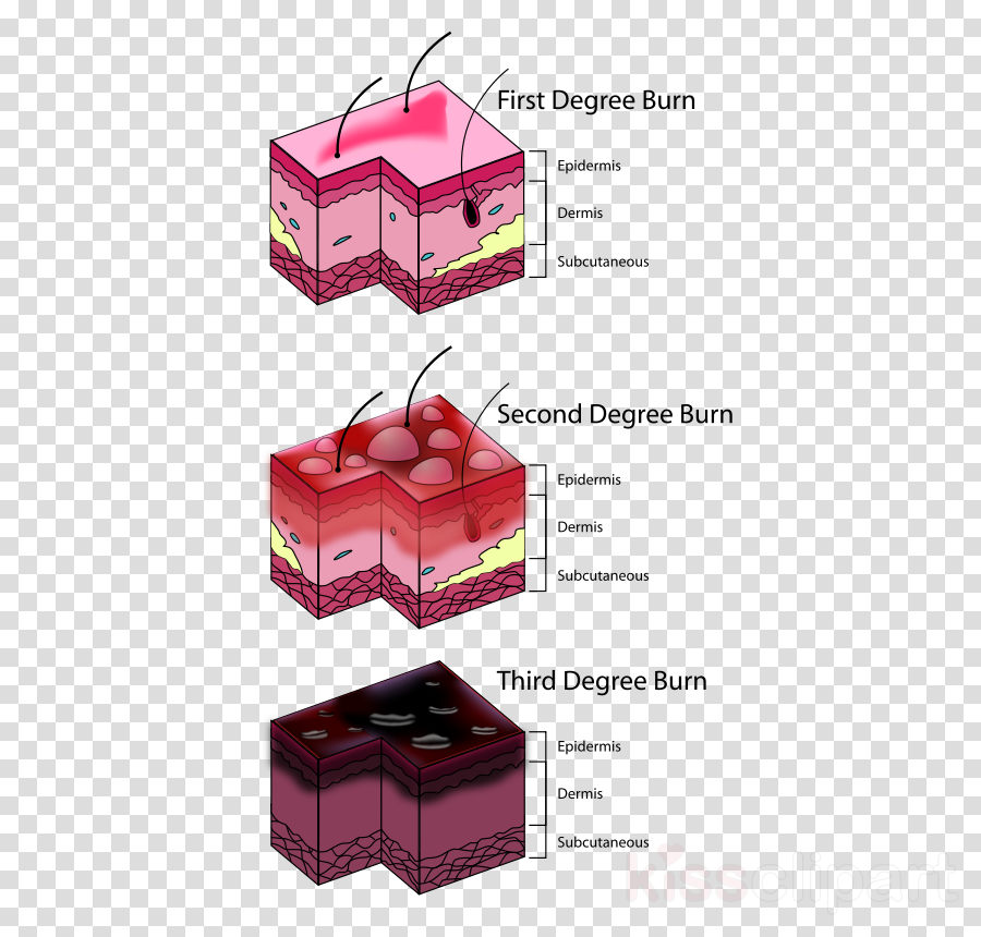 Download Burn Degrees Clipart Burn Injury First Aid Supplies PNG Image ...