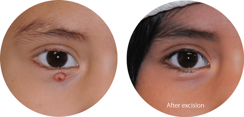Pyogenic Granuloma Of A Lower Eyelid Before And After - Eyelid - Free ...