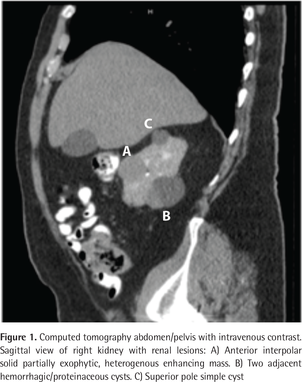 Download In The Anterior Interpolar Region, There Was A Partially PNG ...