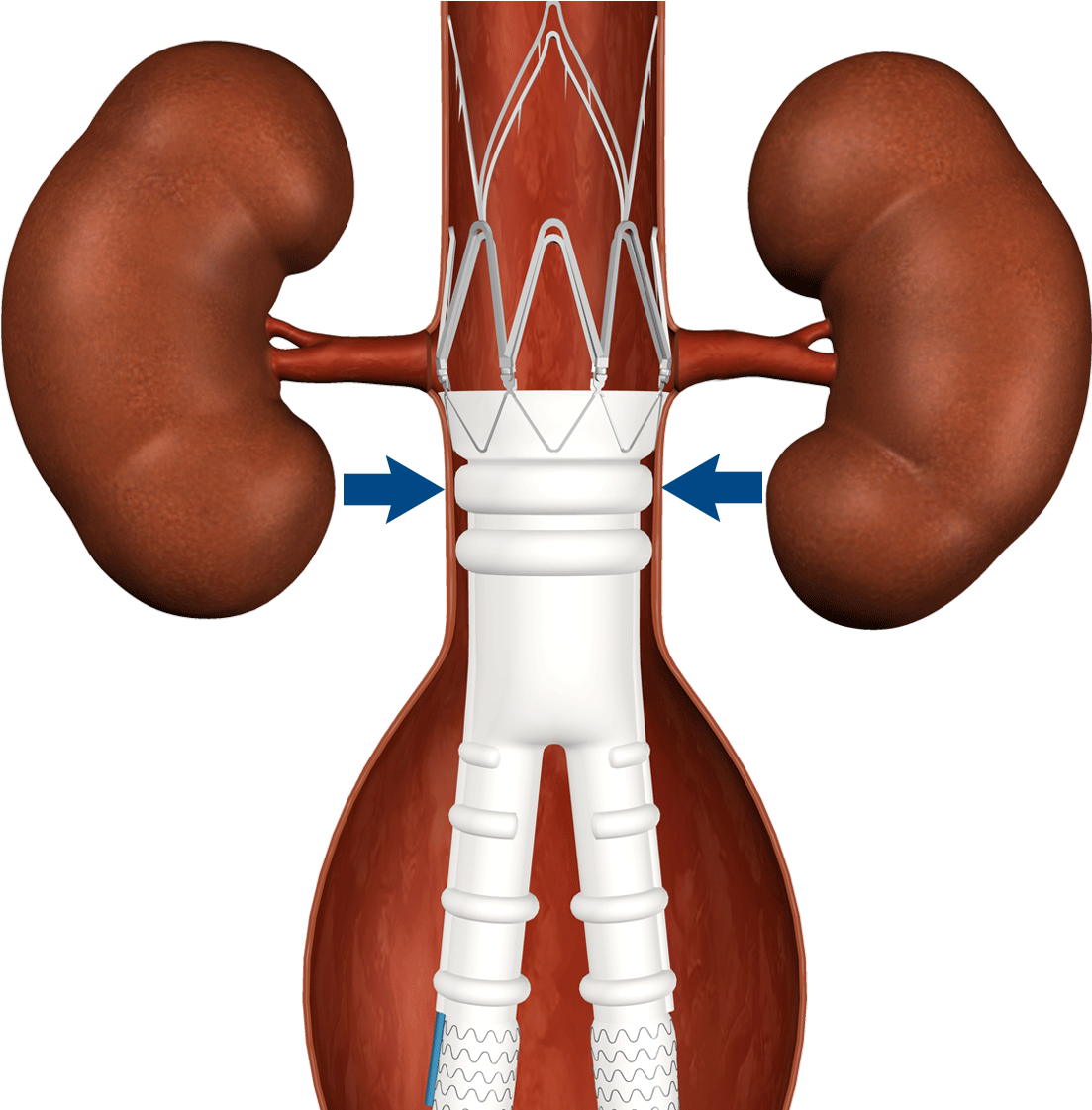 Download Stent Graft Comparison PNG Image with No Background - PNGkey.com