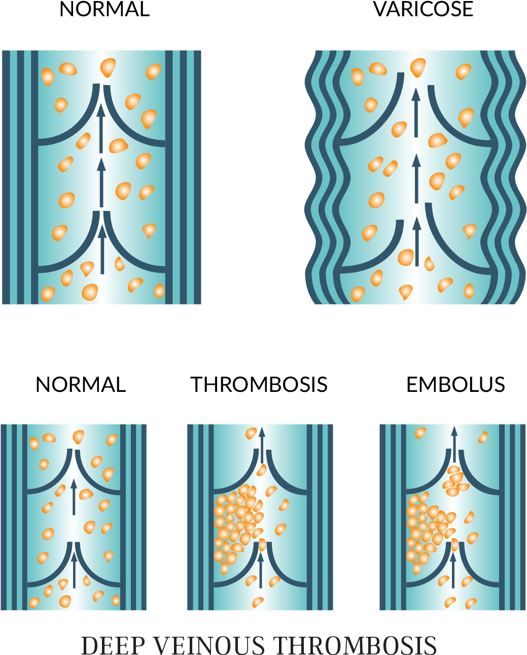 Varicose Veins - Graphic Design - Free Transparent PNG Download - PNGkey