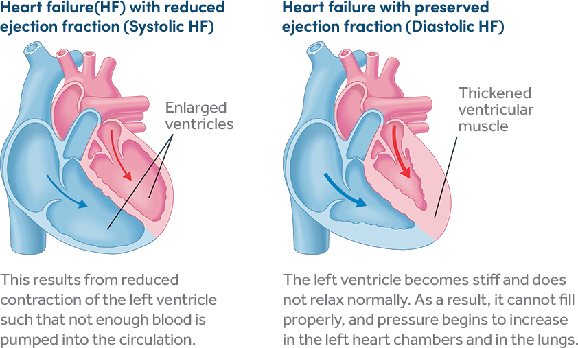 Download Two Types Of Heart Failure - Diagram PNG Image with No ...