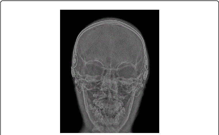 Download Plain Trans Orbital Skull Film Taken Intra Operatively ...