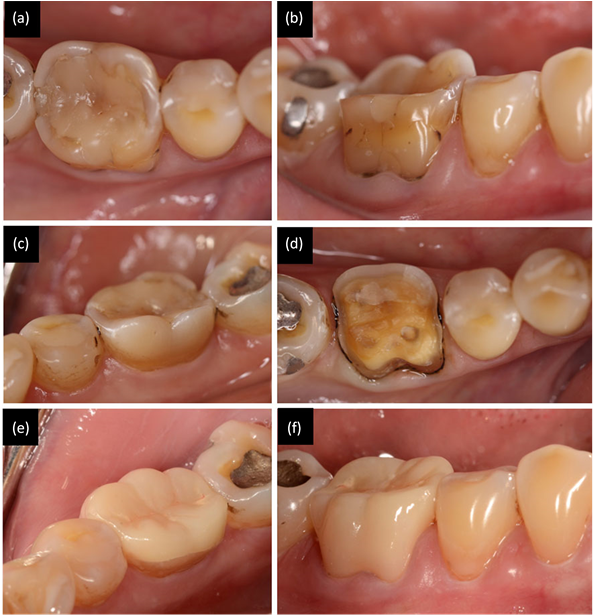 Download The Lower First Molar Tooth Has Large Resin Composite ...