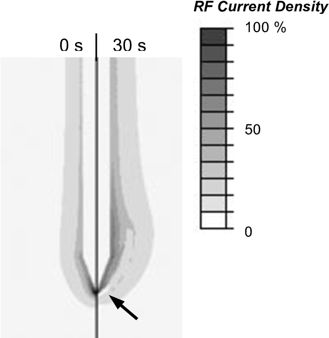 Download Electrical Rf Current Density For Cooled Needle Electrode ...