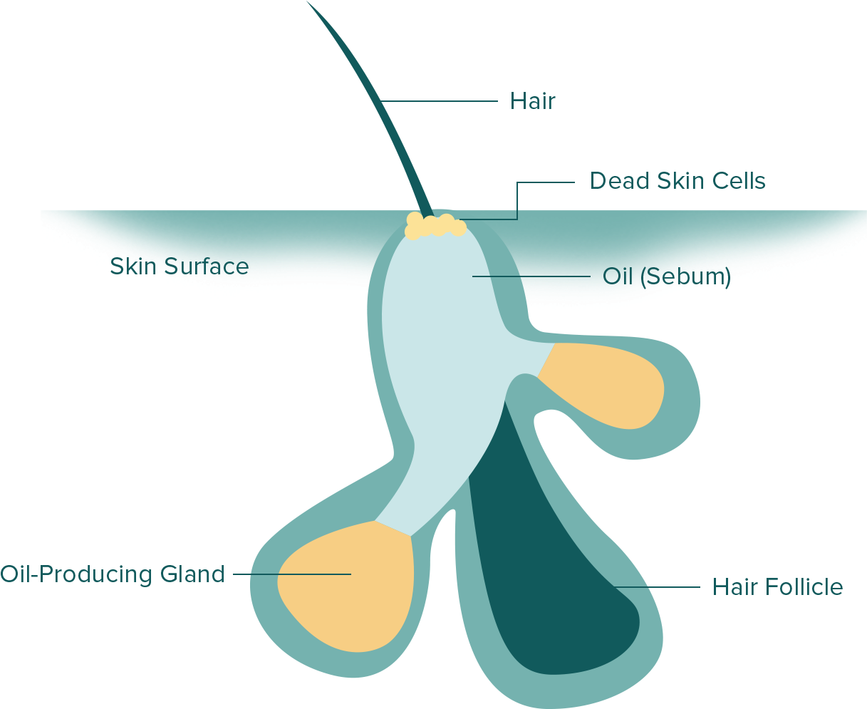 Download What Is Acne - Graphic Design PNG Image with No Background ...